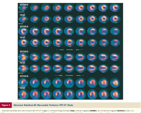 Figure 1 From Diagnostic Accuracy Of Rubidium 82 Myocardial Perfusion Imaging With Hybrid