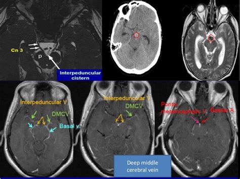 Cisterns Of Brain And Its Contents Along With Its Classification And