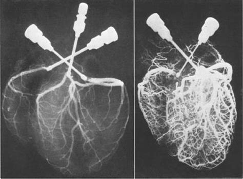 Eecp體外反搏 — Goodspring