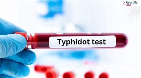 Typhidot Test Price Purpose Procedure Results And More