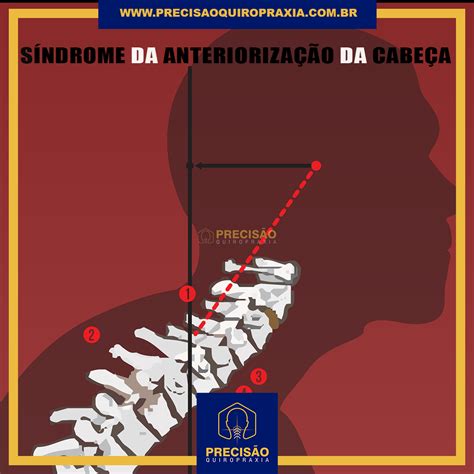 O Que é A Síndrome Da Anteriorização Cabeça Precisão Quiropraxia