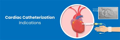 Cardiac Catheterization Indications Types And Risks