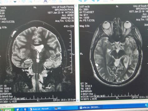 Epilepsy Support Australia Epilepsy And Personality Bringing Epilepsy Out Of The Shadows “in A