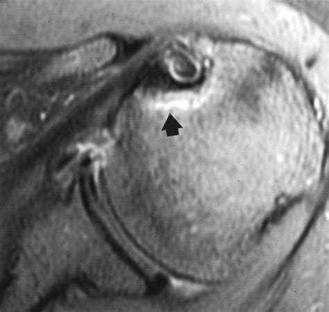 Subcoracoid Impingement Shoulder And Elbow Orthobullets