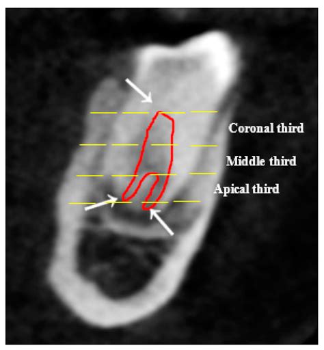 Diagnostics Free Full Text Prevalence Of Second Root And Root Canal