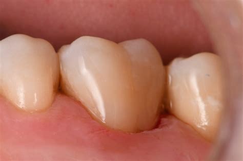 How To Design Class V Root Composite Restorations