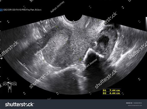 Uterus Ultrasound Transvaginal