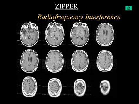 Artifacts In Mri