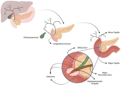 Ampulla Of Vater Transduodenal Ampullectomy For Early Ampullary