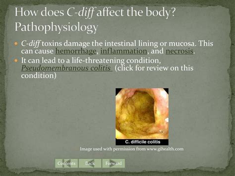 Ppt So Your Patient Has C Diff Now What Powerpoint Presentation