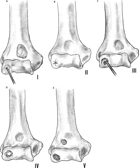 Osteochondral Defects In The Elbow Musculoskeletal Key