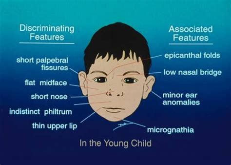Signs And Symtoms Microcephaly