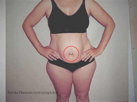 Hernia Or Diastasis Recti What Is The Difference