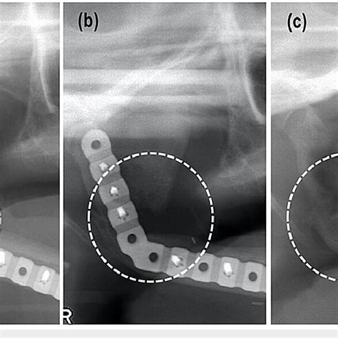 Recurrence At The Resection Margin In Patient 12 A Panoramic