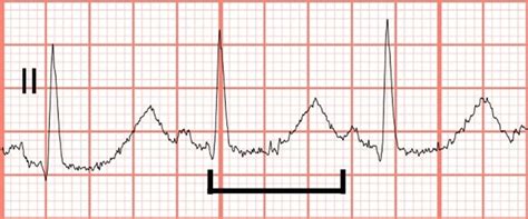 Hypocalcemia Ekg Prolonged Qt