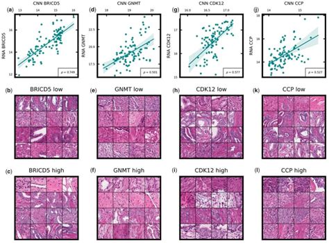 Transcriptome Wide Prediction Of Prostate Cancer Gene Expression From