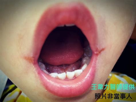 疱疹唇炎疼痛有礙觀瞻可能是免疫力低下或營養不良親子天下