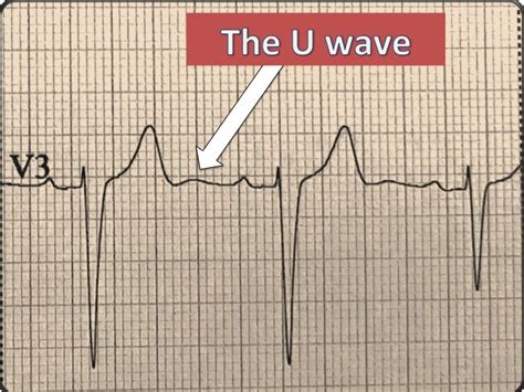 Ecg 101 The Ecg Paper Explained — The Pr