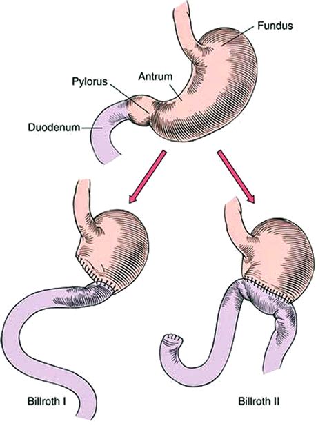 Post Surgical Anatomy And Ercp Techniques In Gastrointestinal Endoscopy