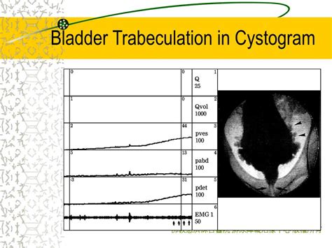 Bladder Trabeculation