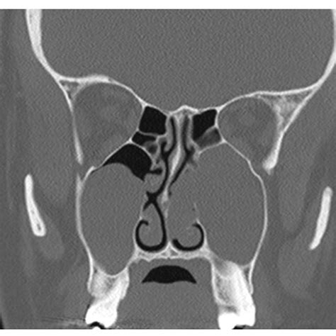 Ct Scan Demonstrating Opacification Of The Maxillary Sinuses