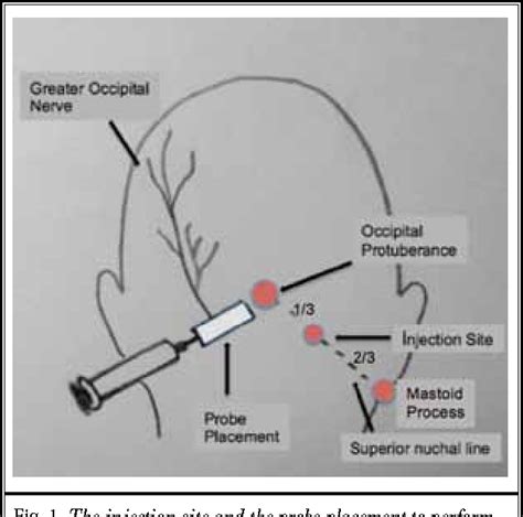 Cpt Code Occipital Nerve Block At Marcos Hines Blog