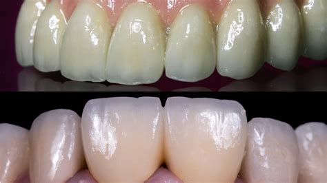 Pfm Vs Zirconia Crown Comparative Guide For Dentists