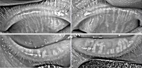 Addressing Age Related Meibomian Gland Dysfunction