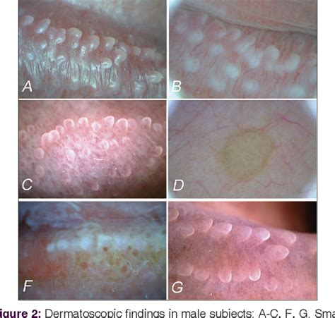 Do Pearly Penile Papules Grow In Size