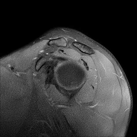 Bankart Lesion Mri