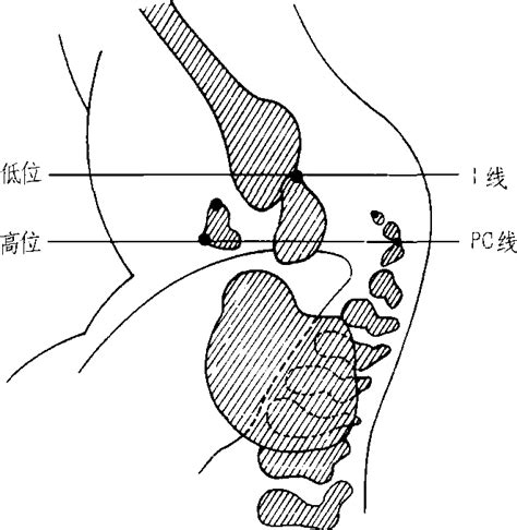 一 X线倒置位摄片法 图2 9 现代肛肠外科手术 医学