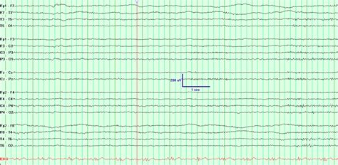 Drowsy Stage 1 Sleep