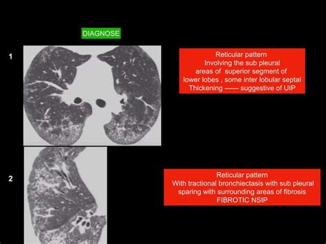 Patterns In Hrct Chest Pptx Lung And Respiratory Health Diseases