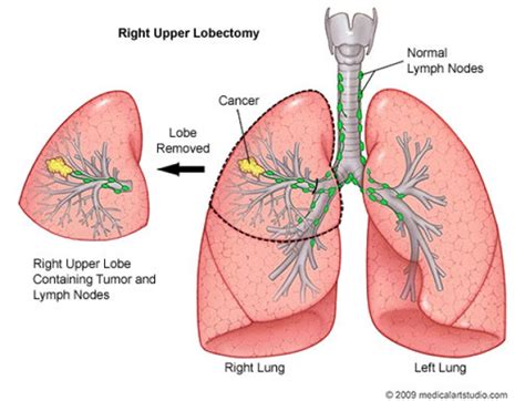 Role Of Surgery In Lung Infection Daily Excelsior