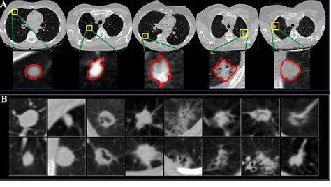 Figure From Benign Malignant Pulmonary Nodule Classification In Low Dose CT With Convolutional