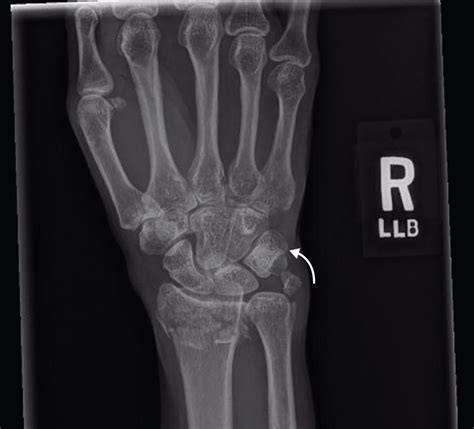 Associated Ulnar Fixation Ulnar Styloid And Metadiaphyseal Fractures Clinical Tree