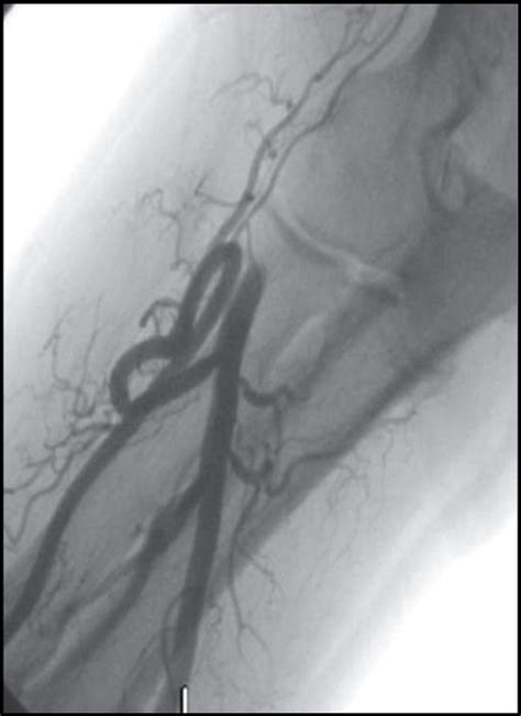 Complex Radial Artery Loop With 2 Recurrent Radial Arteries Originating