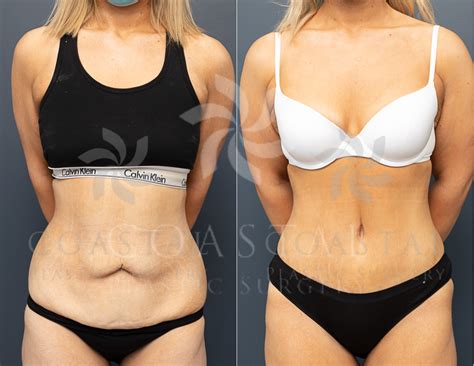 Abdominoplasty Gallery Before And After Results Sydney