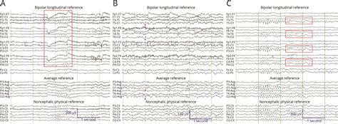 Teaching Neuroimage Pictures Of Health In Pediatric Eeg Neurology