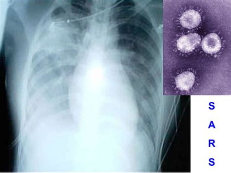 Pneumonia Classification And Etiology Ppt