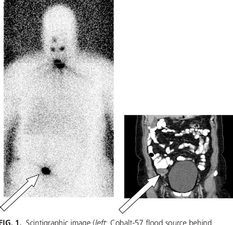 Figure 1 From Scintigraphic Detection Of Benign Ovarian Teratoma After
