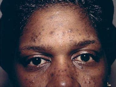 Eosinophilic Folliculitis Background Pathophysiology Epidemiology