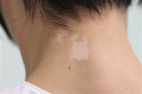 光線治療 西三河の皮膚科美容皮膚科あおい皮フ科クリニック肌美容のお悩みに