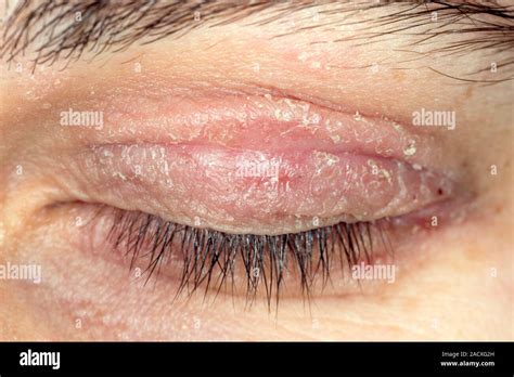 Eyelid Dermatitis Eyelid Dermatitis Xeroderma Of The Eyelids Eczema