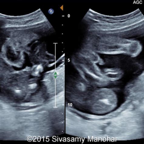 📃 Twin Reversed Arterial Perfusion Sequence Trap Sequence