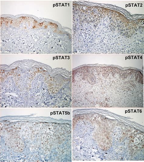 Representative Paraffin‐embedded Tissue Samples From The Lesional Skin Download Scientific