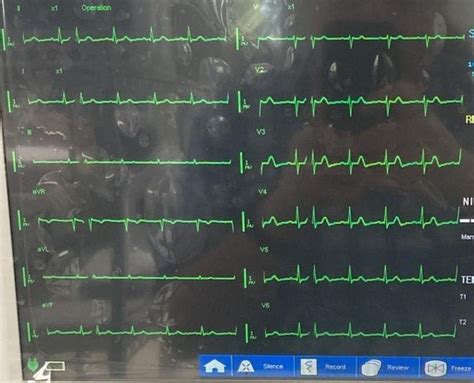Ekg 12 Pacetech Healthcare Inc 12 Lead Ekg