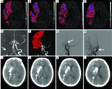 Imaging Of A Patient With Ph2 A D Preoperative Adc Map Showing The
