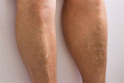 Solar Lentigo On Legs