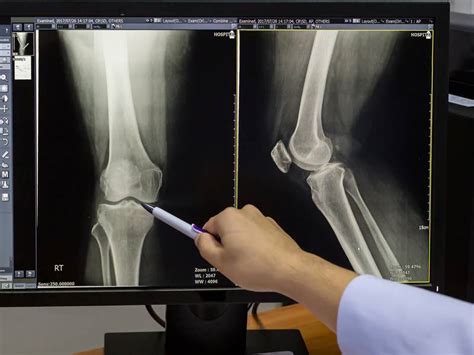 What Is An Arthrogram Michigan Diagnostics